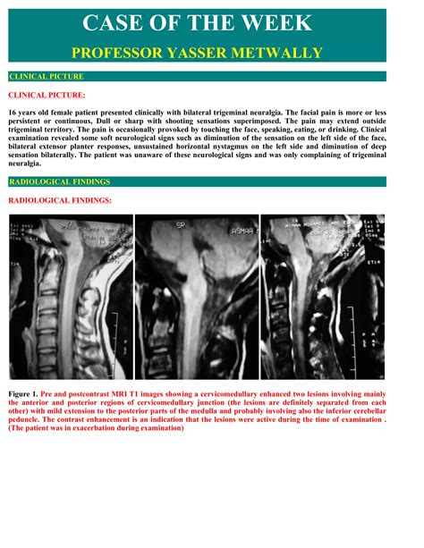 Case Recordmultiple Sclerosis Presented Clinically With Bilateral