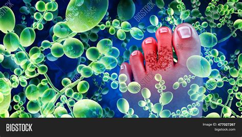 Foot Fungus From Hotel At Jamie Tolentino Blog