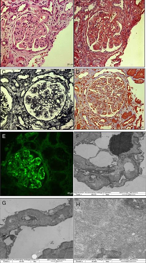 A D Glomeruli With Increased Volume Lobulated Aspect Endocapillary