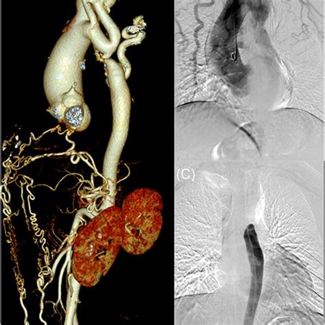 A And B Case 1 Computated Tomography Angiography Revealed A Type Download Scientific