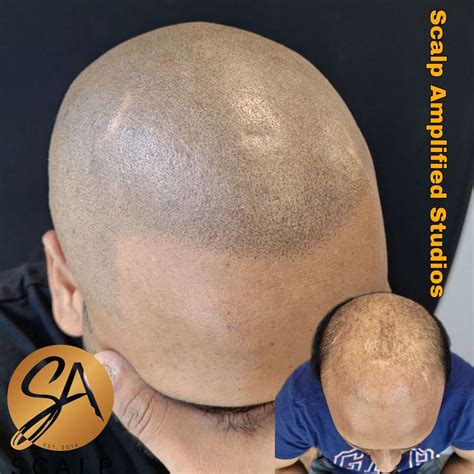 Scalp Micropigmentation Before And After Examples Scalp Amplified Scalp Micropigmentation Before And After Examples Scalp Amplified