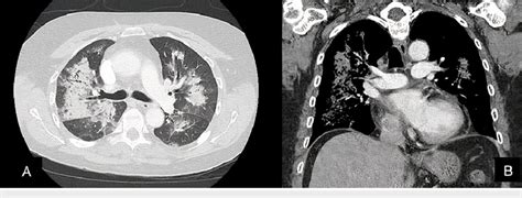 A B Ct Chest Displaying Diffuse Consolidation Throughout Lung Fields Download Scientific Diagram