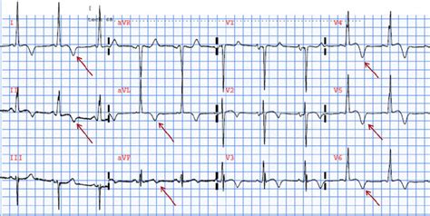 Markedly Abnormal Ecg In A Patient With Hypertrophic Cardiomyopathy
