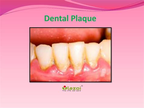 Ppt Dental Plaque Powerpoint Presentation Free Download Id 7945755