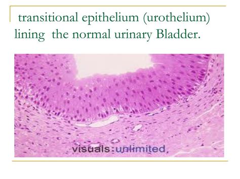 Ppt Bladder Carcinoma Powerpoint Presentation Free Download Id 6685750