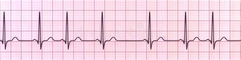 Respiratory Sinus Arrhythmia 3d Illustration Stock Illustration