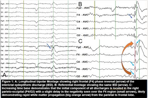 Understanding Epilepsy Networks And Rapid White Matter Propagation Of