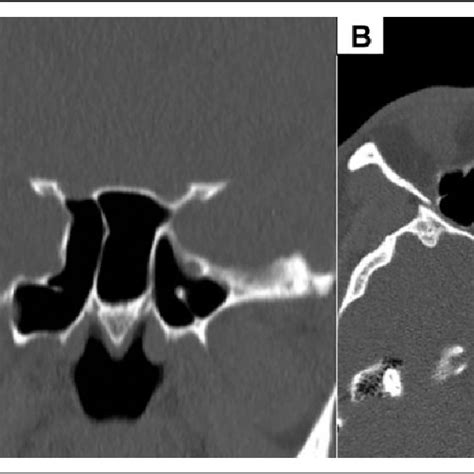 The Sinus Pneumatization Pattern Was Classified As Conchal Presellar Download Scientific
