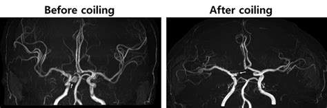 Magnetic Resonance Angiography Images Obtained Before And After Coil