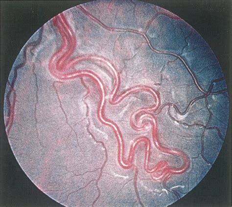 36 Congenital Fundus Abnormalities Ento Key