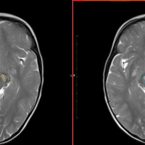 Axial Ct Brain Symmetrical Hypodensities In The Bilateral Caudate Download Scientific Diagram