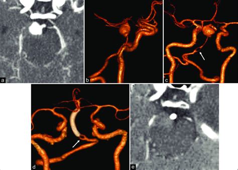 Case 5 A C A Saccular Aneurysm Is Seen Occupying On Basilar Artery