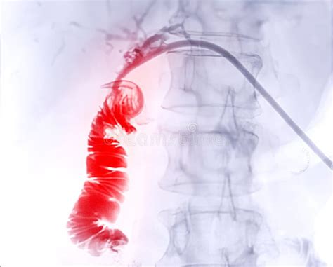 Ercp Procedure Stock Photos Free Royalty Free Stock Photos From Dreamstime