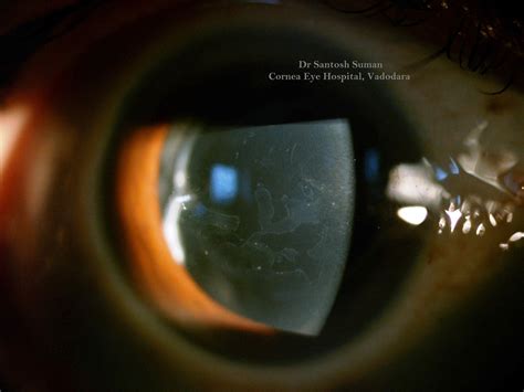Map Dot Fingerprint Corneal Cornea Eye Hospital Facebook