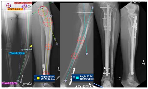 Intramedullary Rod Tibia