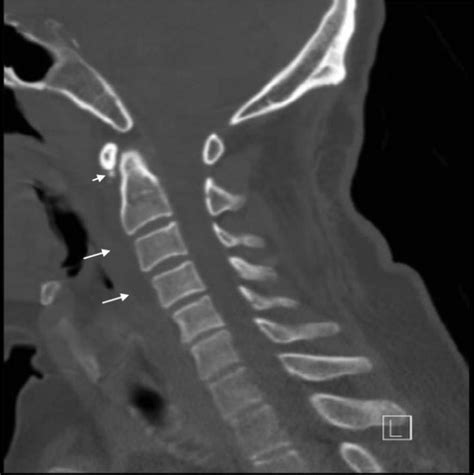 Sagittal Computed Tomography Scan Shows An Amorphous Calcification Download Scientific Diagram