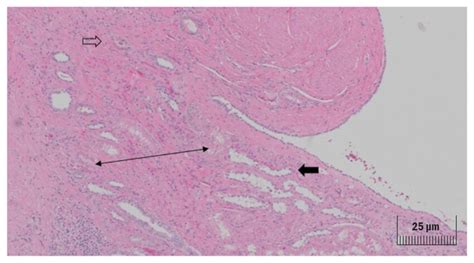 Segment Of Neoplasm Tumor Pattern Black Hollow Arrow And The Borders Download Scientific