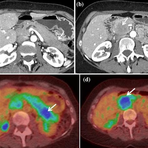 68 Year Old Male With Type 1 Aip Axial Post Contrast Ct Image Before