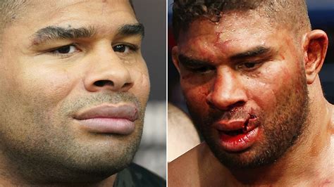El Impactante “antes Y Después” Del Rostro Del Luchador De Ufc Que