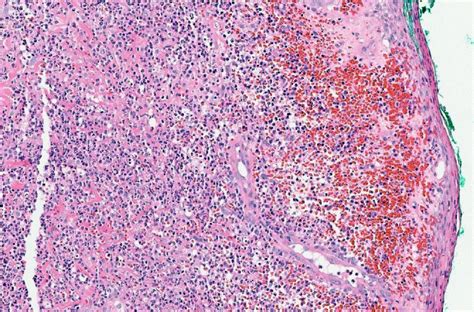 Ecthyma Gangrenosum Histology