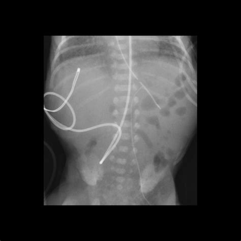 Premature Newborn After Picc Placement Pediatric Radiology Case Pediatric Imaging
