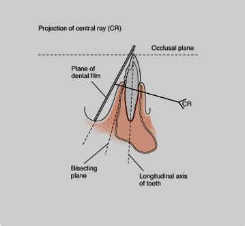 Bisecting Angle Technique Flashcards Quizlet