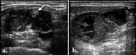 Intranodal Necrosis A Coagulation Necrosis Arrow B Liquefaction