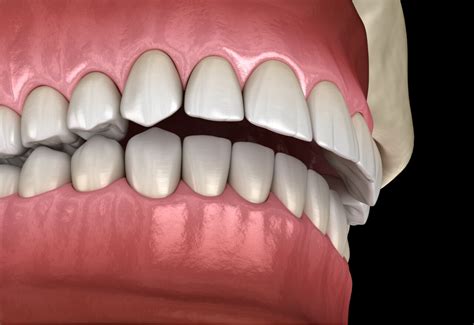 Skeletal Class Iii Malocclusion