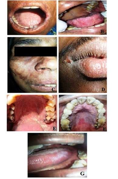 A Angular Stomatitis In An Acquired Immunodeficiency Syndrome Aids