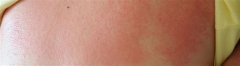 Prickly Heat Rash Symptoms Causes Medikoph