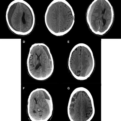 Computerized Tomography Scans Of Representative Cases With Chronic Download Scientific Diagram