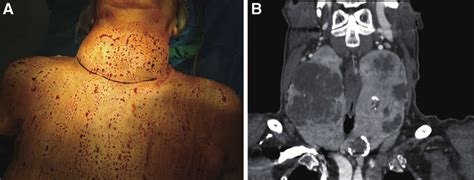 The Preoperative Findings A Inspection Thy Thyroid Gland Enlarged Download Scientific