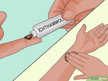 How To Painlessly Remove A Splinter Steps With Pictures