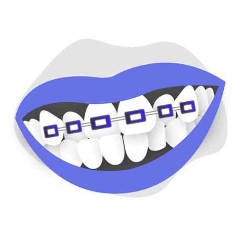 Can Braces Correct Adult Crossbite Smile Prep