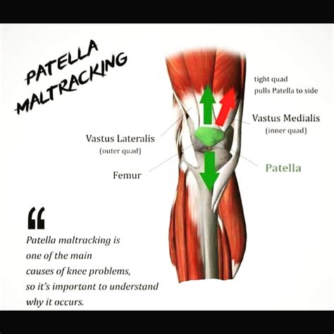 Healvibe What Is Patellar Tracking Disorder Patellar