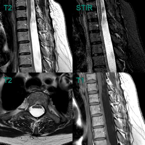 Arachnoid Cyst Neuroradiology