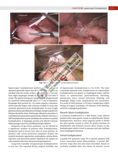 Laparoscopic Fundoplication At World Laparoscopy Hospital Pdf