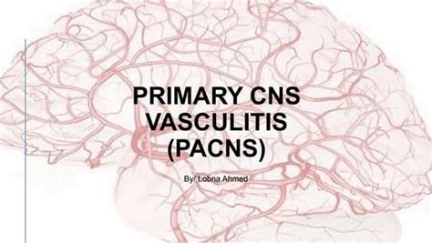 Cns Vasculitis