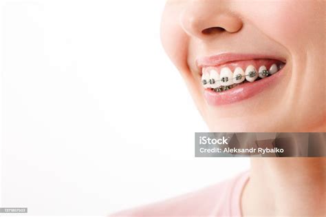 치열 교정 치료 치과 치료 개념 아름다운 여성 건강한 미소가 닫힙다 치아에 세라믹 및 금속 브래킷을 닫습니다 아름다운 여성의 미소 와 중괄호 치아교정기에 대한 스톡 사진 및