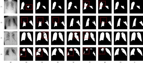 Visual Comparison Of Lung Infection Segmentation Results With Other