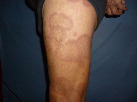 Annular And Polycyclic Lesions On The Lower Limbs Actas Dermo