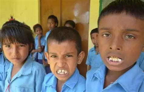 水中氟超标可导致的结果是？ 知乎