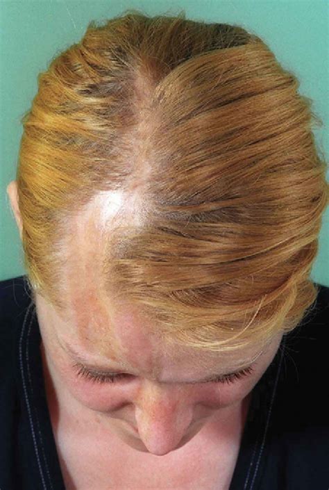 Linear Scleroderma Causes Symptoms Diagnosis Treatment And Prognosis