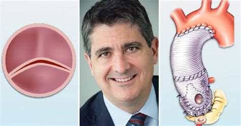 Bicuspid Aortic Valve And Valve Sparing Root Replacement Top 8 Facts