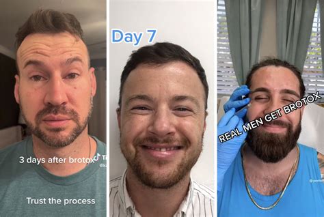 Inside The Rise Of ‘brotox