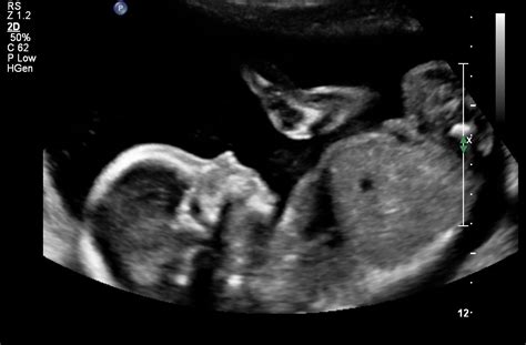 20 Week Profile Picture Any Gender Clues Please