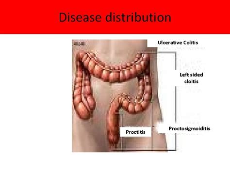 Ulcerative Colitis Disease Distribution Ulcerative Colitis Left Sided