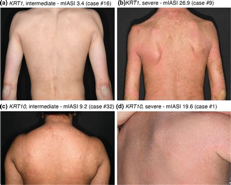 Epidermolytic Ichthyosis Symptoms Successful Topical Adapalene Treatment For The Facial