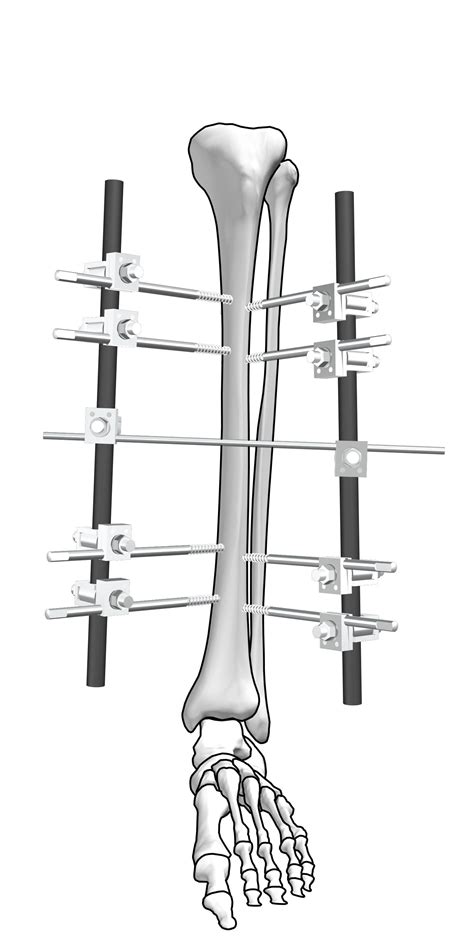 Orthopedic Trauma Implant Medical Device Dissection II Φ 11 Tibia External Fixation China