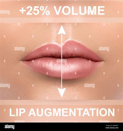 Comparison Of Female Lips After Augmentation With Filler Injections